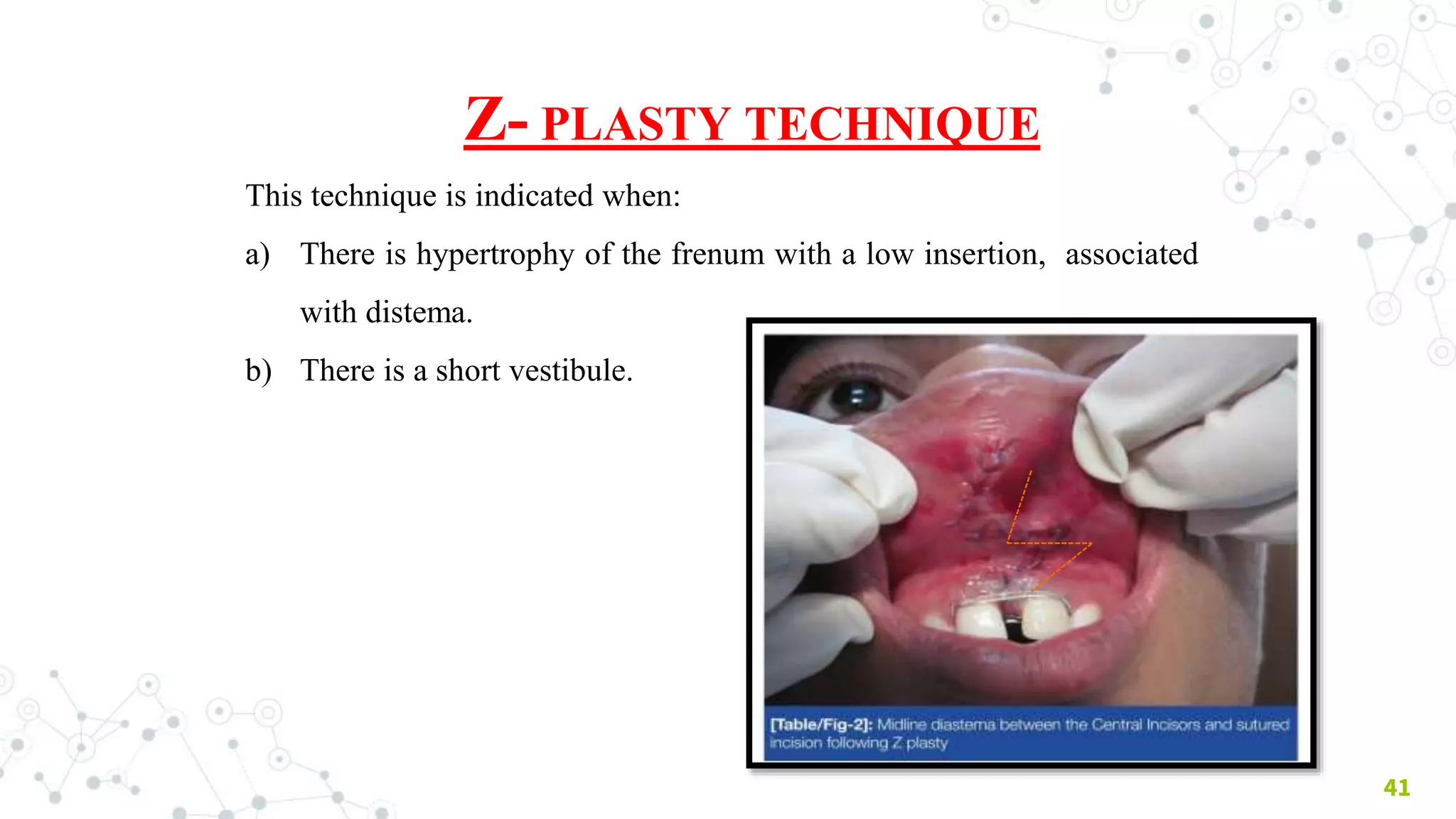 FRENAL ATTACHMENT & ITS MANAGEMENT | PPTX