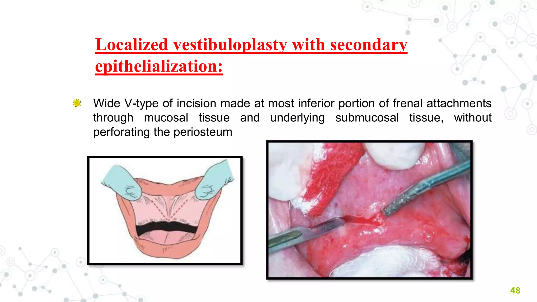 FRENAL ATTACHMENT & ITS MANAGEMENT | PPTX
