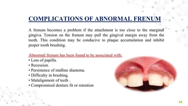 FRENAL ATTACHMENT & ITS MANAGEMENT | PPTX | Oral care | Personal Care