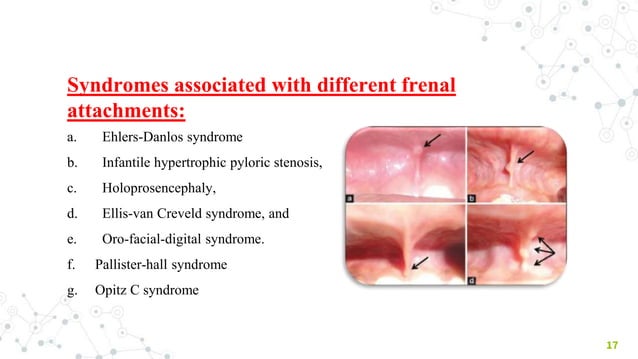FRENAL ATTACHMENT & ITS MANAGEMENT | PPTX | Oral care | Personal Care