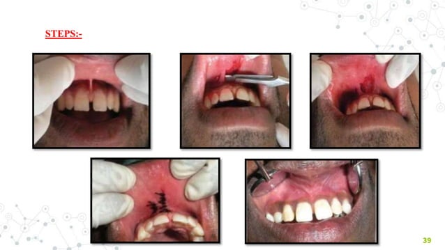 FRENAL ATTACHMENT & ITS MANAGEMENT | PPTX | Oral care | Personal Care
