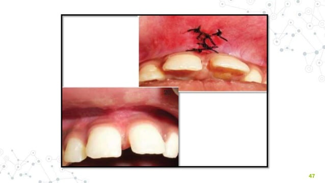 FRENAL ATTACHMENT & ITS MANAGEMENT | PPTX | Oral care | Personal Care