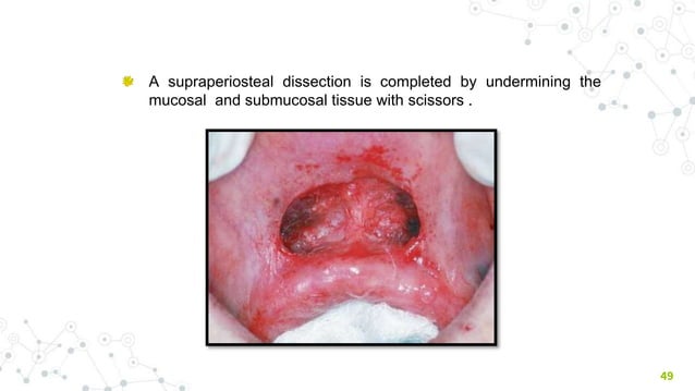 FRENAL ATTACHMENT & ITS MANAGEMENT | PPTX | Oral care | Personal Care