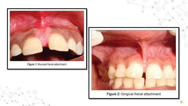 FRENAL ATTACHMENT & ITS MANAGEMENT | PPTX | Oral care | Personal Care