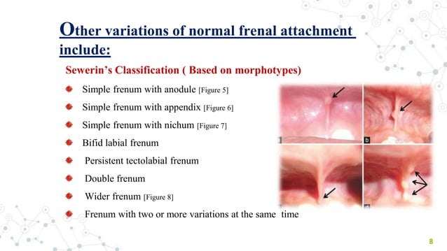 FRENAL ATTACHMENT & ITS MANAGEMENT | PPTX | Oral care | Personal Care