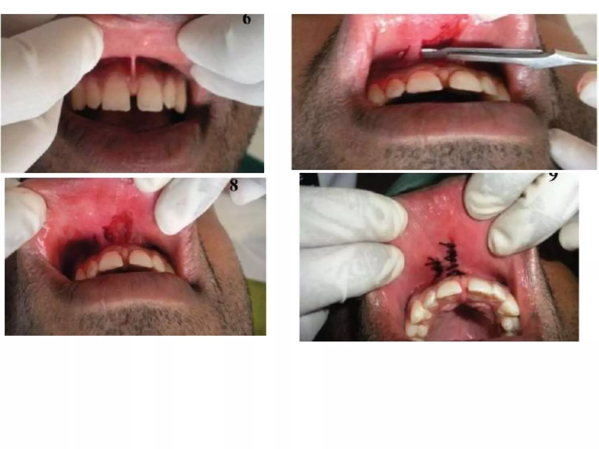 Frenum attachment and it's management. | PPTX