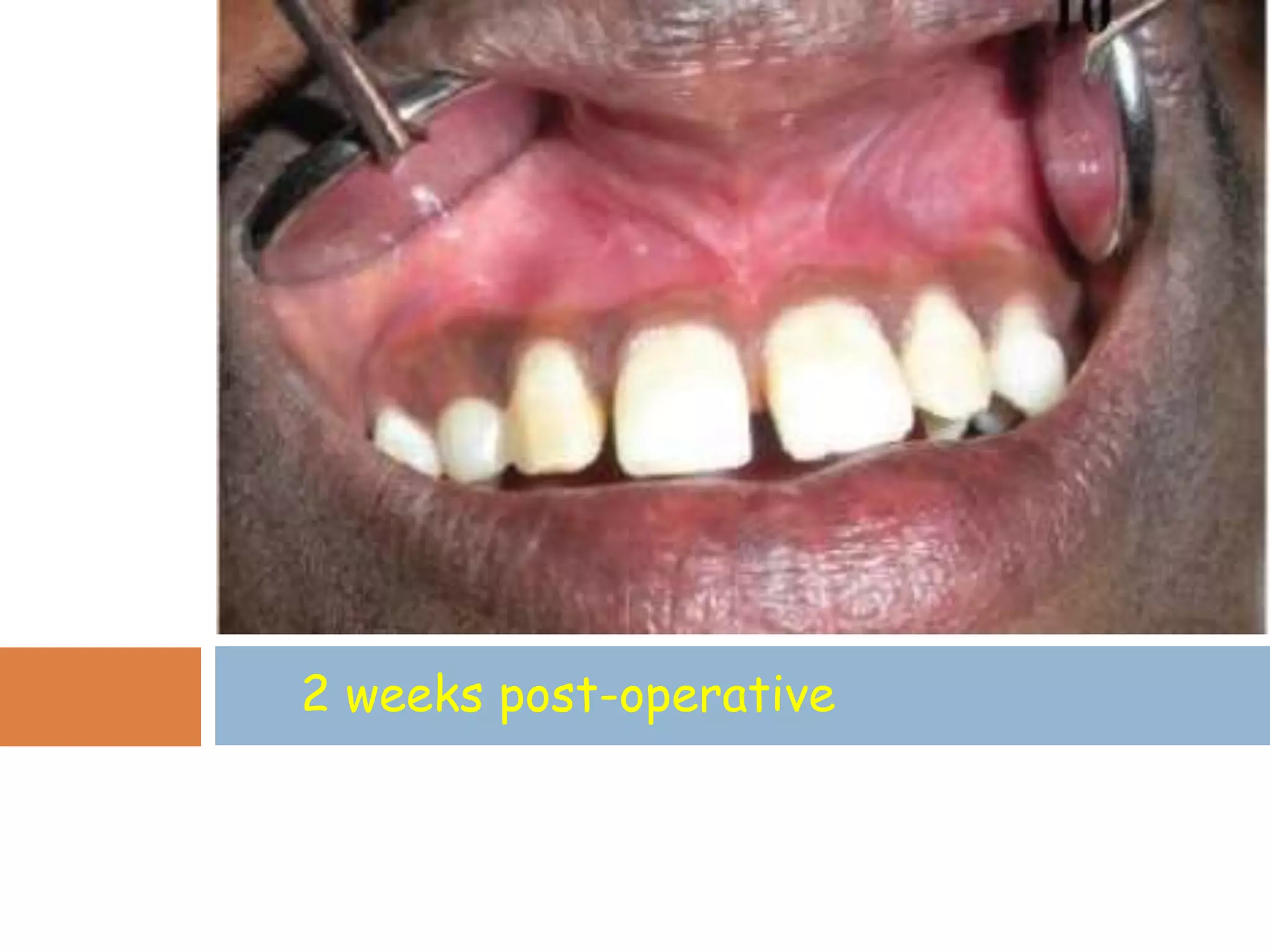 Frenum attachment and it's management. | PPTX