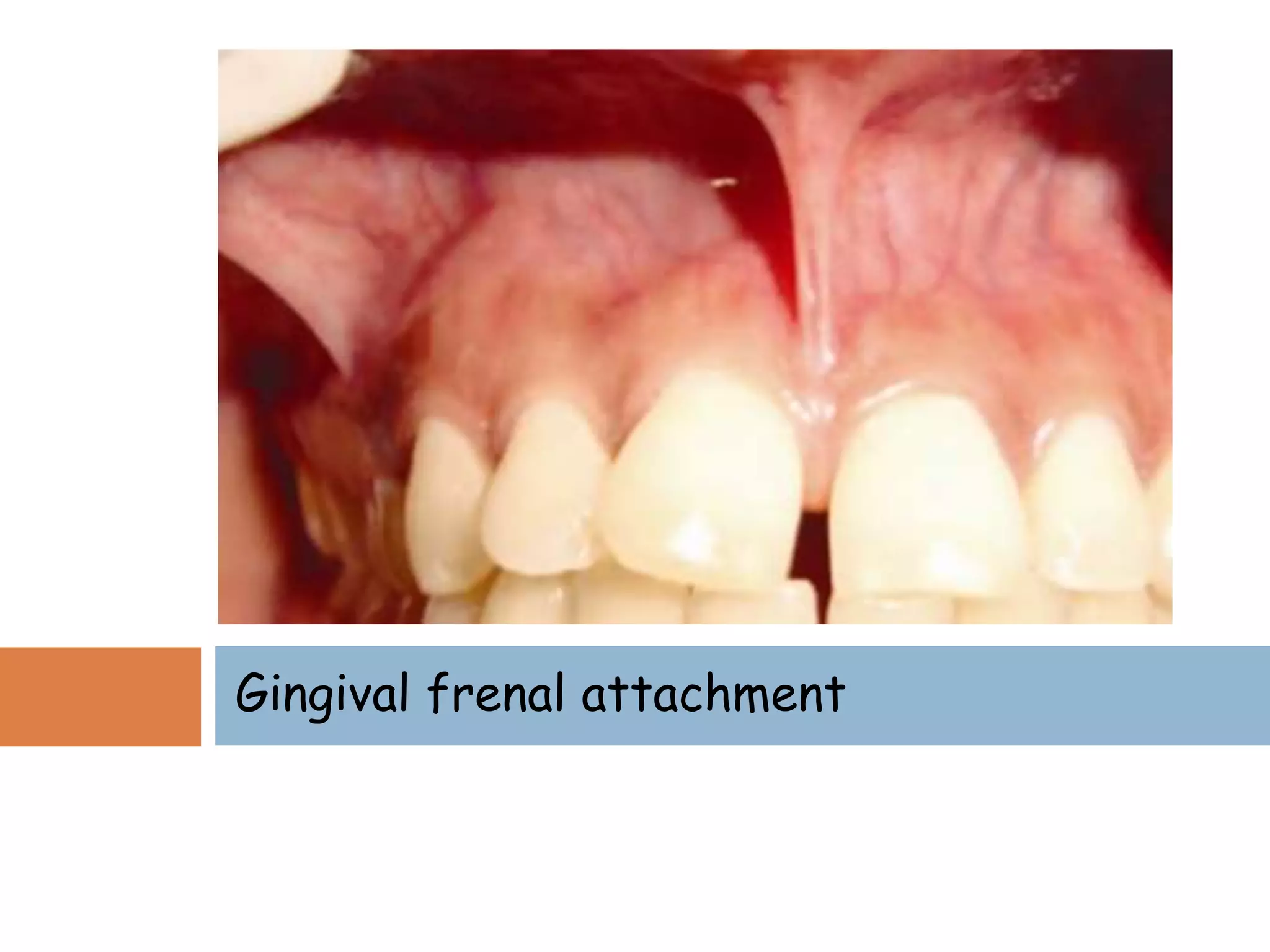 Frenum attachment and it's management. | PPTX