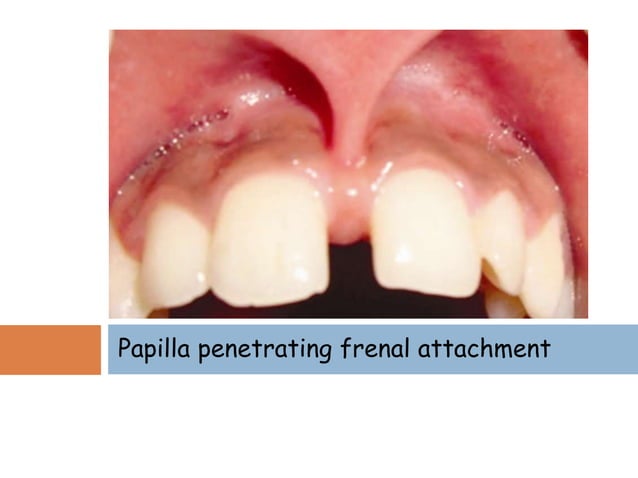Frenum attachment and it's management. | PPTX | Ear, Nose and Throat ...