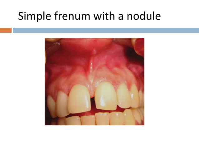 Frenum attachment and it's management. | PPTX | Ear, Nose and Throat ...
