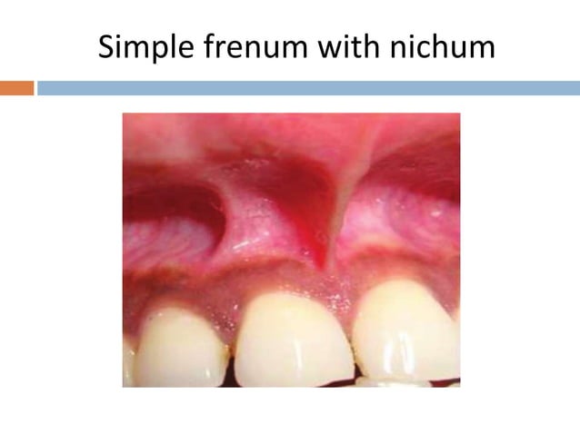 Frenum attachment and it's management. | PPTX | Ear, Nose and Throat ...