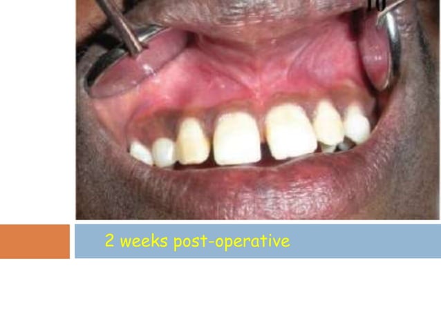 Frenum attachment and it's management. | PPTX | Ear, Nose and Throat ...