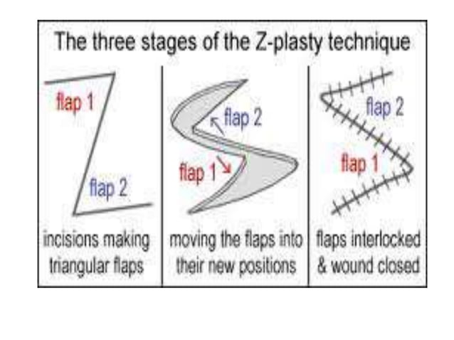 Frenum attachment and it's management. | PPTX | Ear, Nose and Throat ...