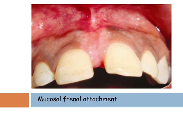 Frenum attachment and it's management. | PPTX | Ear, Nose and Throat ...