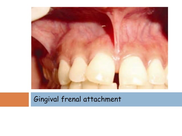 Frenum attachment and it's management. | PPTX | Ear, Nose and Throat ...