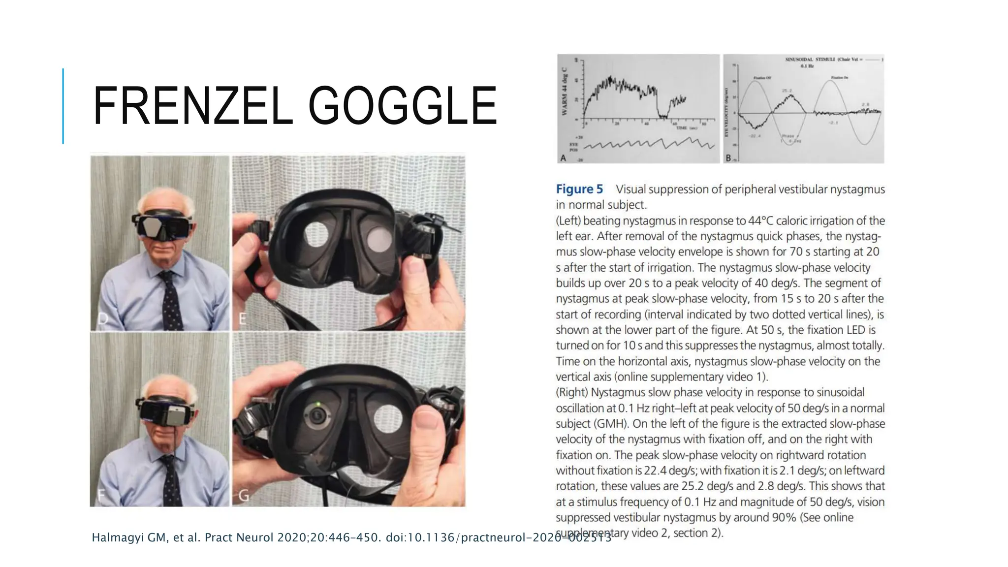 Frenzel Goggles nystagmus how to examine | PPTX