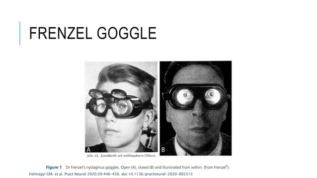 Frenzel Goggles nystagmus how to examine | PPTX