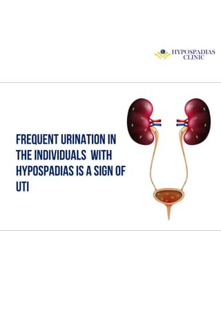 Frequent Urination in the individuals with Hypospadias is a sign of UTI.pdf