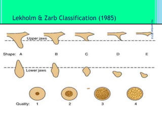 Fresh socket implant placement | PPTX