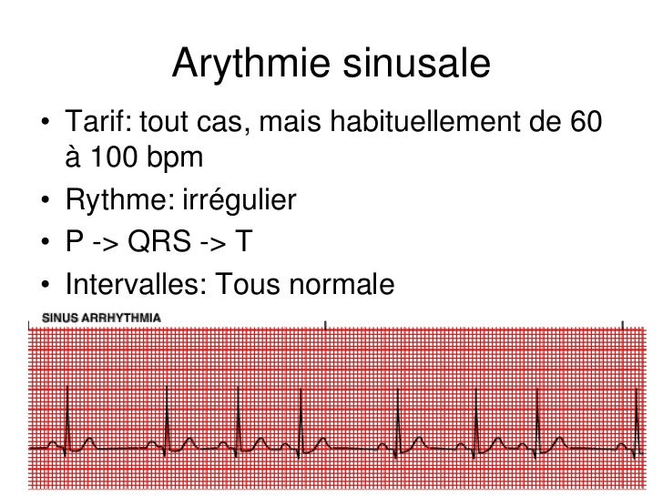 Base ECG et l'interprétation du rythme (French) Symposia