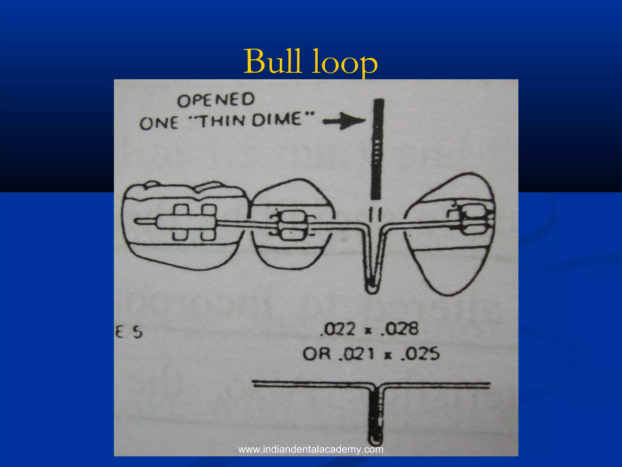 Friction less mechanics in orthodontics /certified fixed orthodontic ...