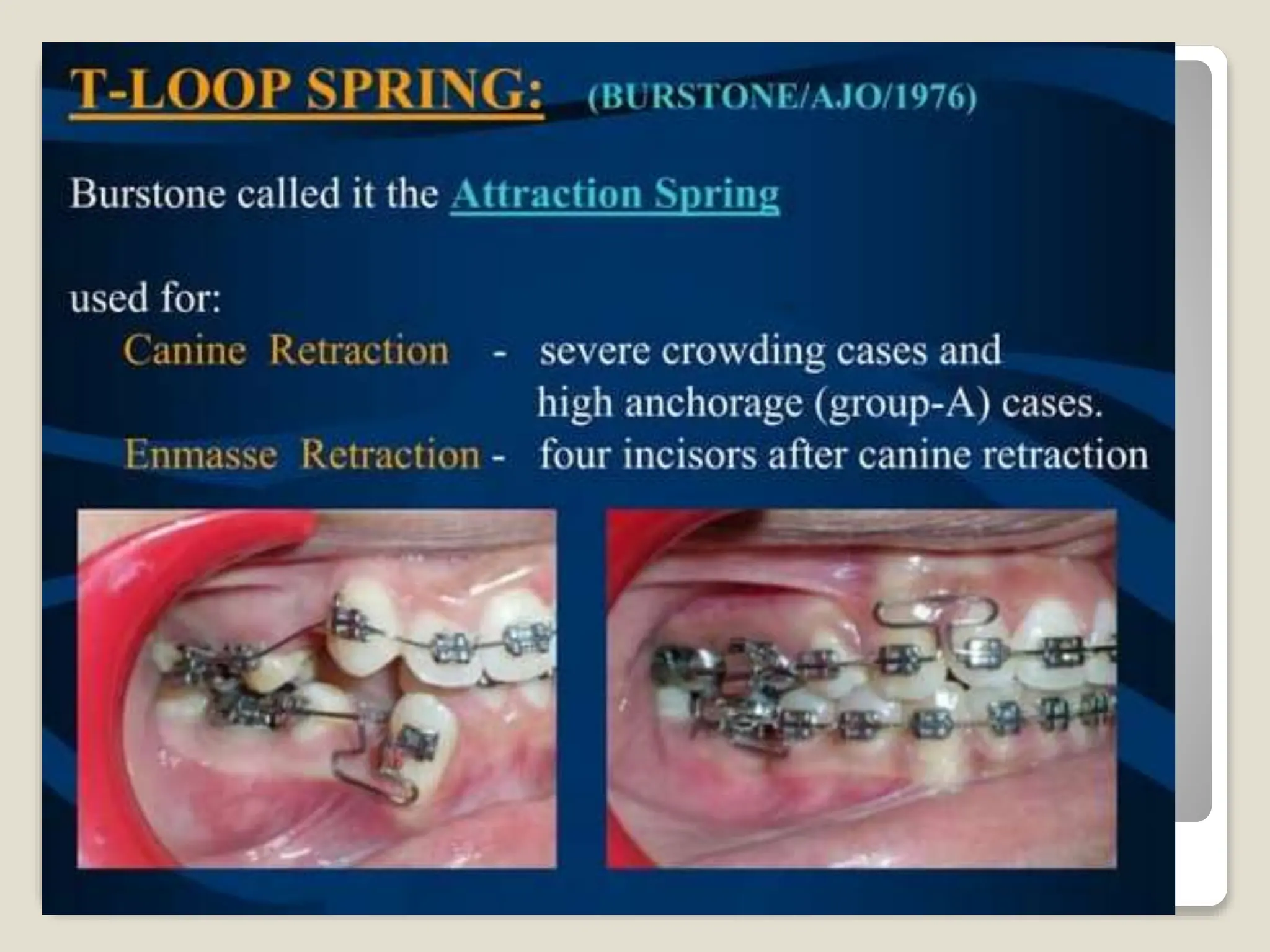 FRICTIONLESS MECHANICS in orthodontics tooth movement.pptx