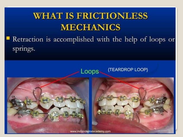 FRICTIONLESS MECHANICS in orthodontics tooth movement.pptx