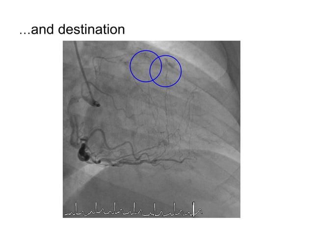 Friday 08:52 – Yuste - Basics of CTO PCI: Reading the angiogram of a ...