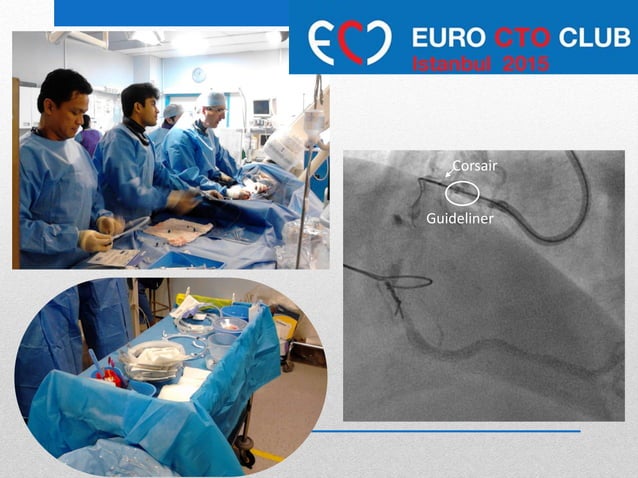 Friday 1145 Di mario - how to set up a cto program in a cath lab | PPT