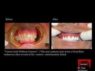 Front row-smile-gallery | PPTX