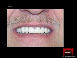 Front row-smile-gallery | PPTX