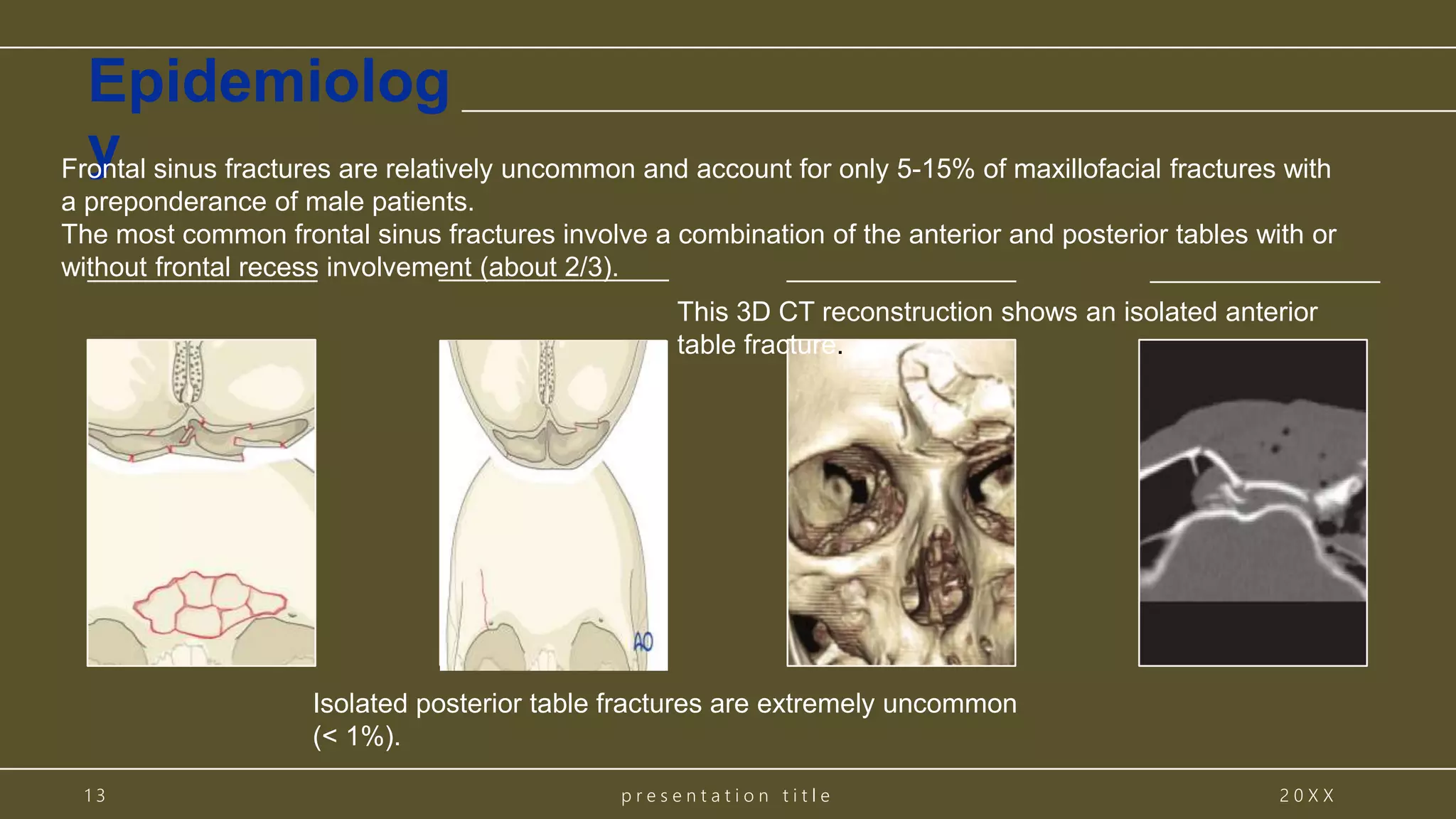 FRONTAL BONE FRACTURE AND ITS MANAGEMENT.pptx