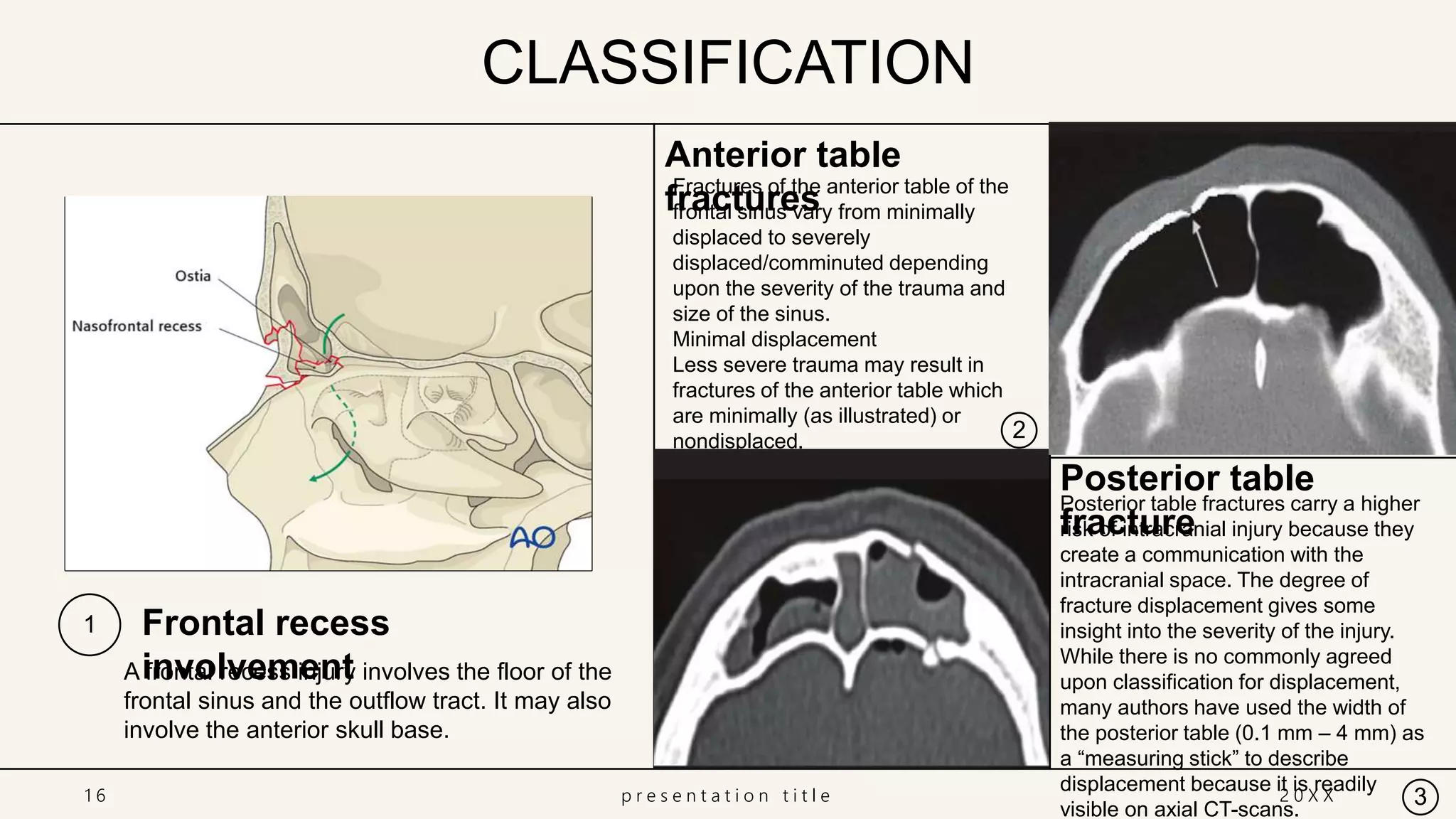 FRONTAL BONE FRACTURE AND ITS MANAGEMENT.pptx