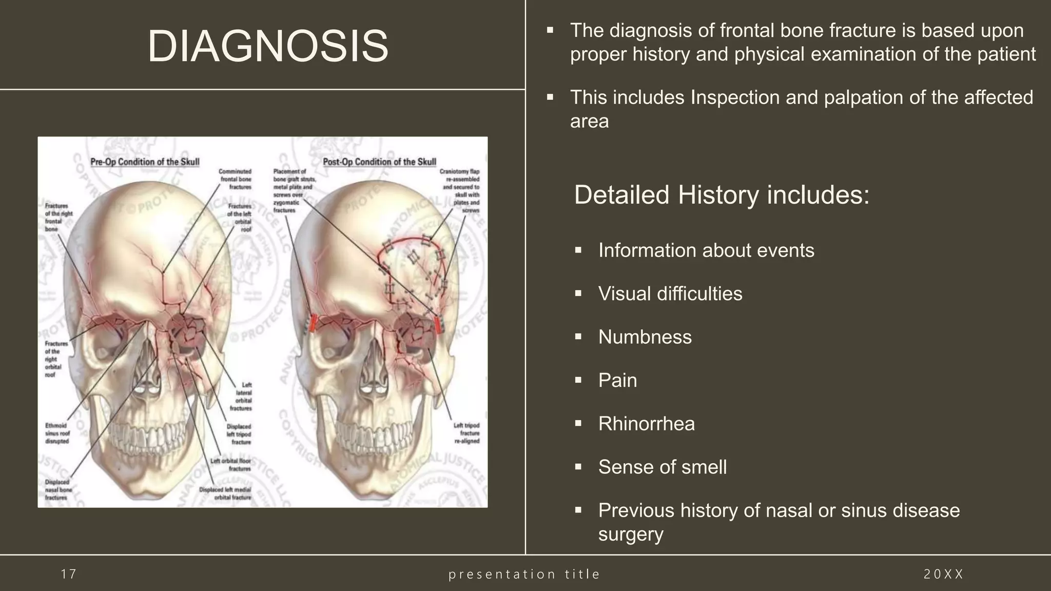 FRONTAL BONE FRACTURE AND ITS MANAGEMENT.pptx