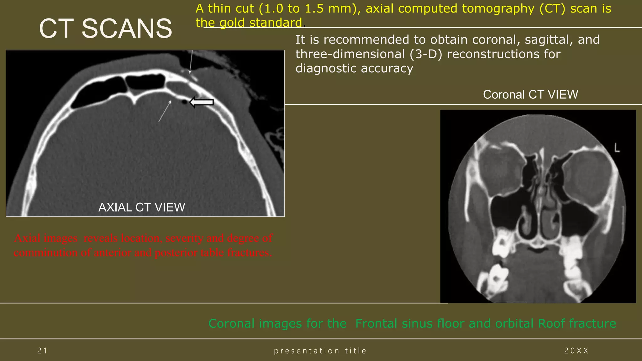 FRONTAL BONE FRACTURE AND ITS MANAGEMENT.pptx