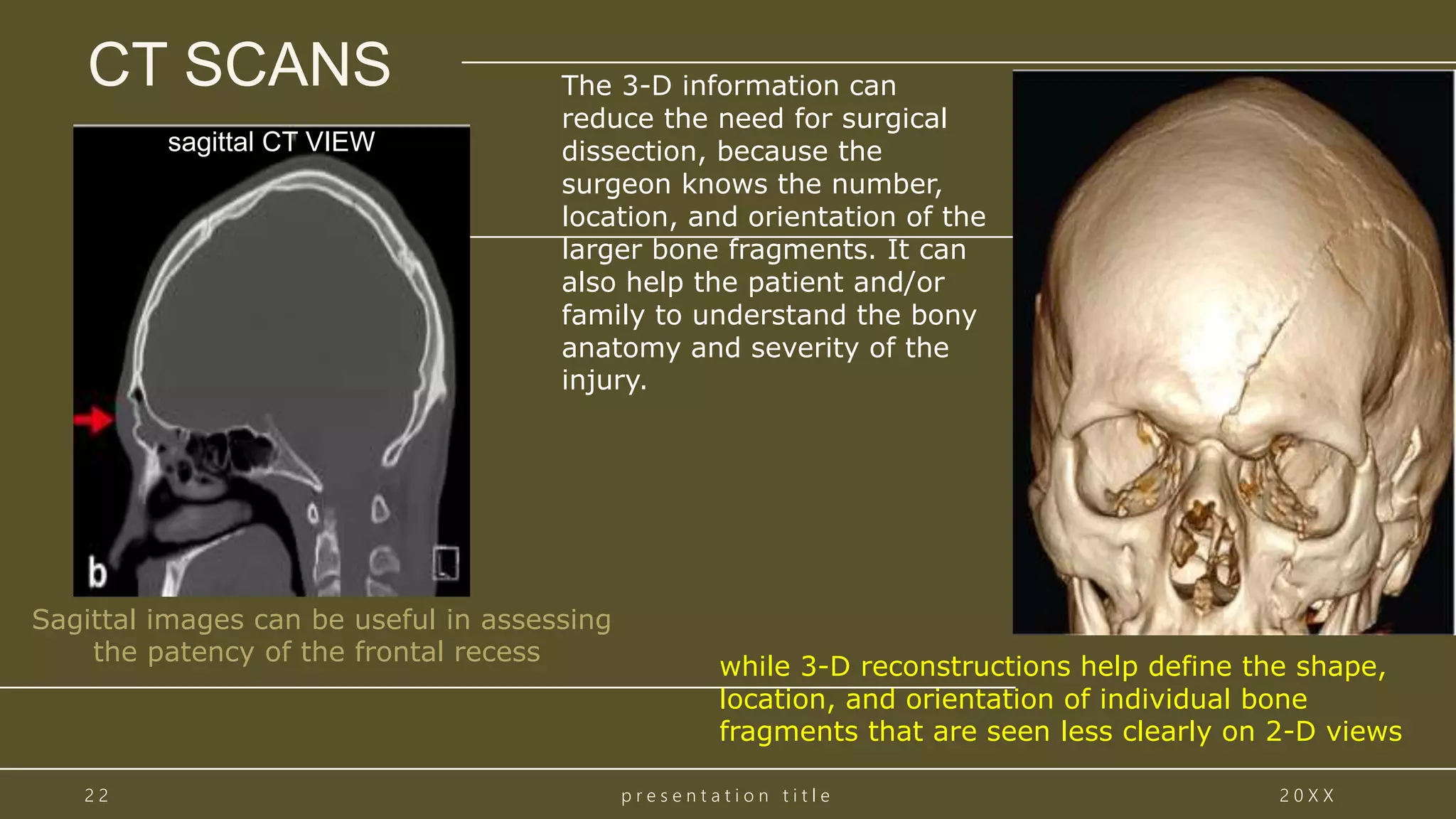 FRONTAL BONE FRACTURE AND ITS MANAGEMENT.pptx