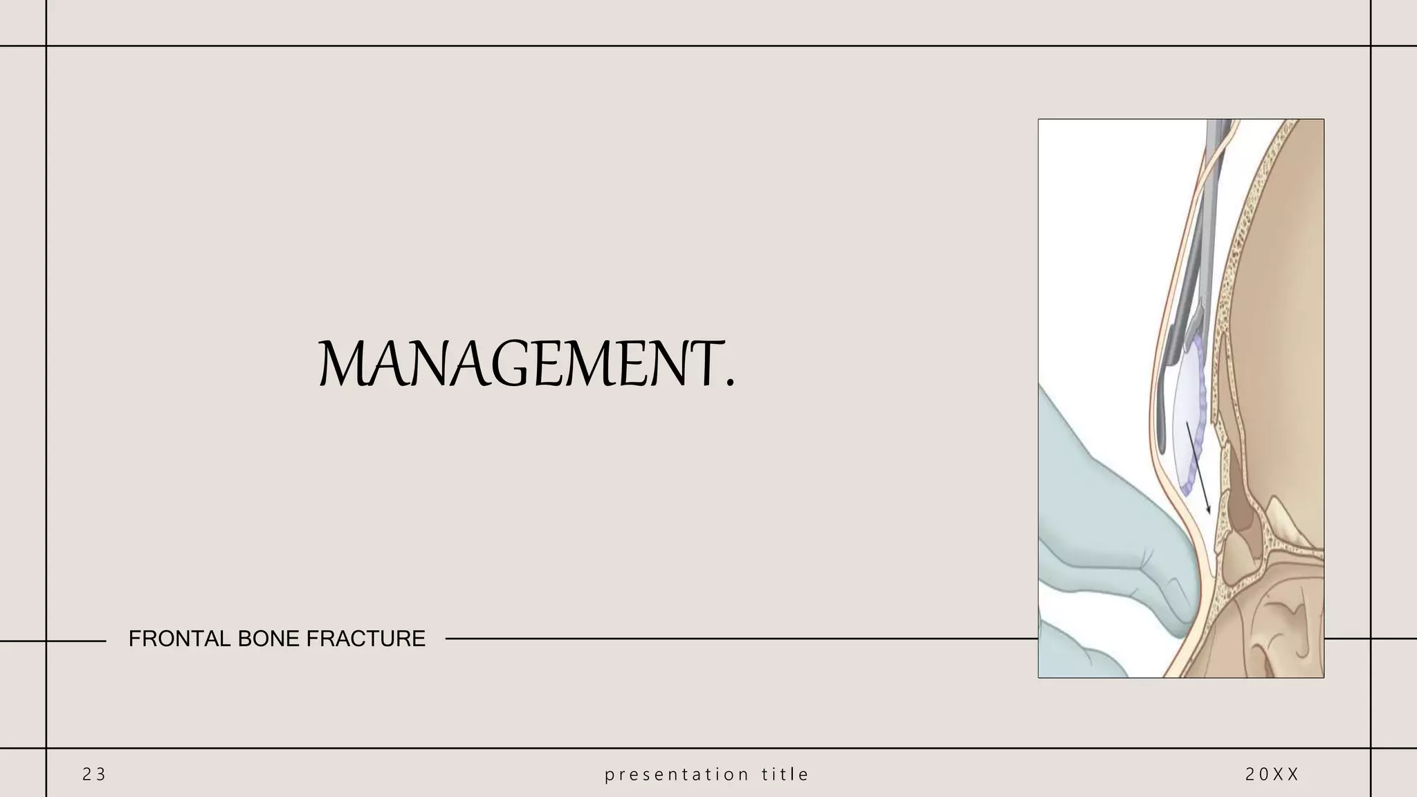 FRONTAL BONE FRACTURE AND ITS MANAGEMENT.pptx