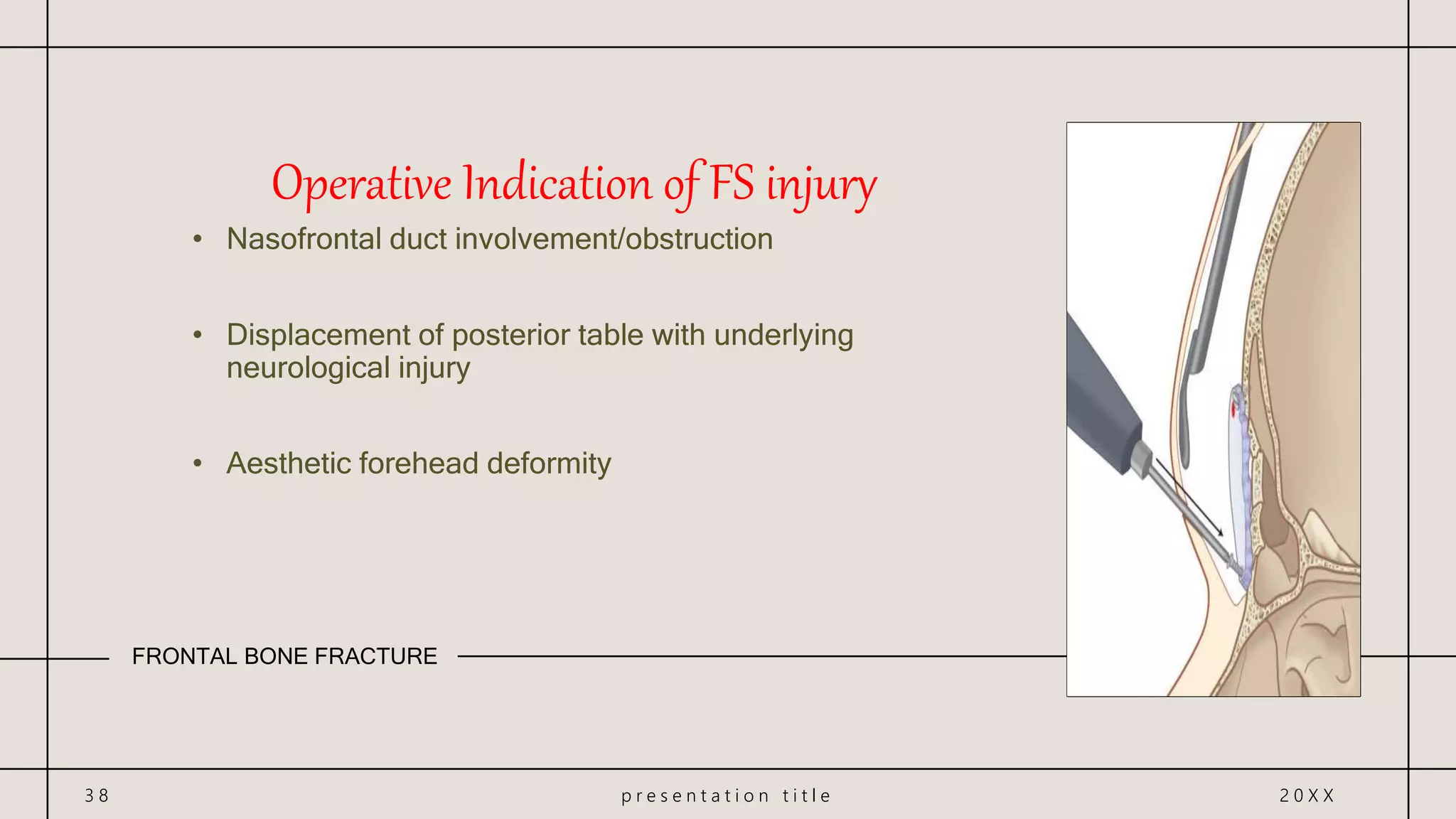 FRONTAL BONE FRACTURE AND ITS MANAGEMENT.pptx