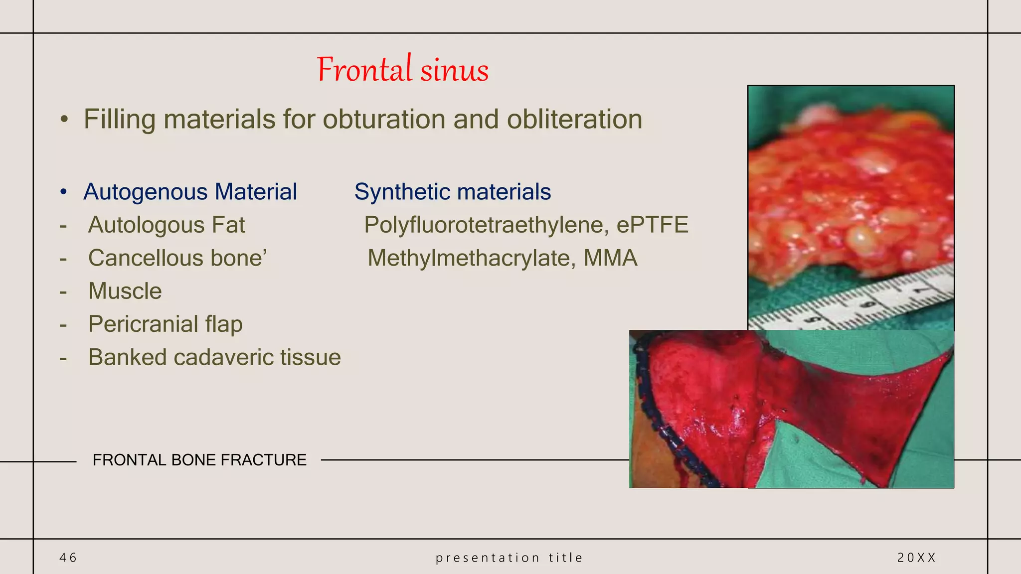 FRONTAL BONE FRACTURE AND ITS MANAGEMENT.pptx