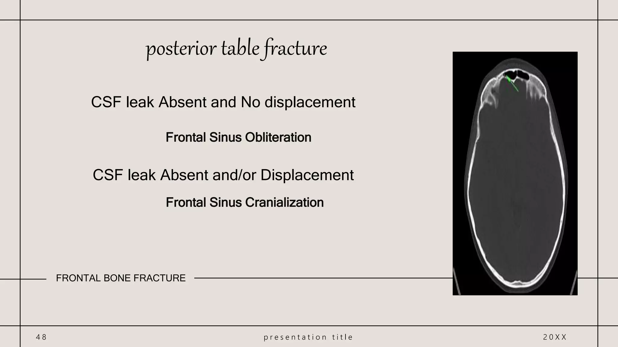 FRONTAL BONE FRACTURE AND ITS MANAGEMENT.pptx
