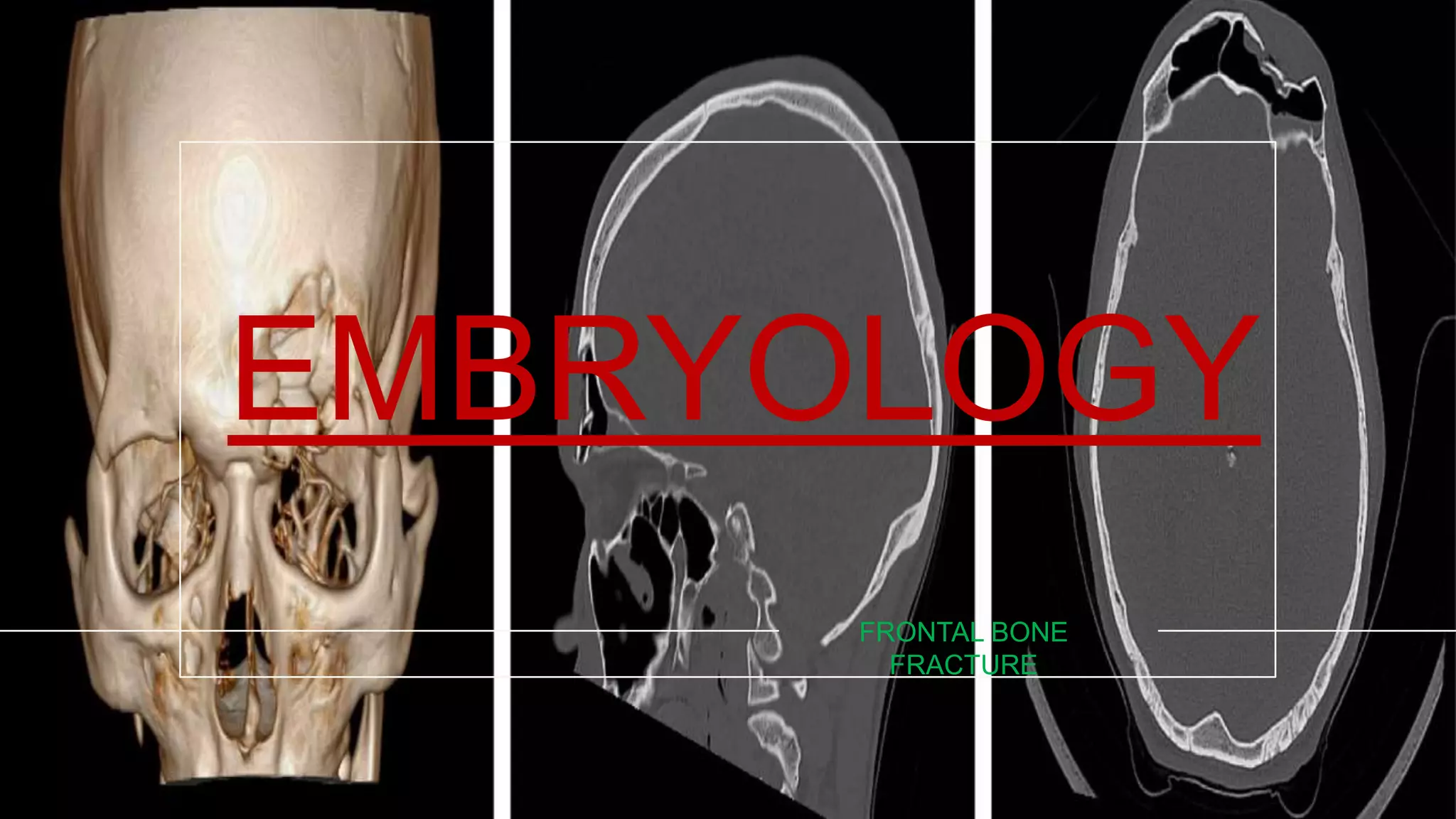 FRONTAL BONE FRACTURE AND ITS MANAGEMENT.pptx