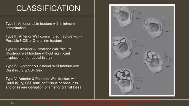 FRONTAL BONE FRACTURE AND ITS MANAGEMENT.pptx | Death, Injury, or ...