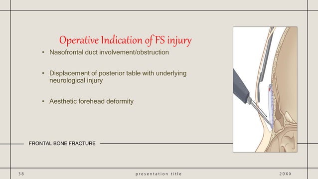 FRONTAL BONE FRACTURE AND ITS MANAGEMENT.pptx | Death, Injury, or ...
