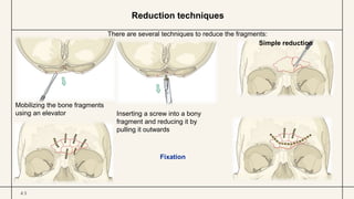 FRONTAL BONE FRACTURE AND ITS MANAGEMENT.pptx