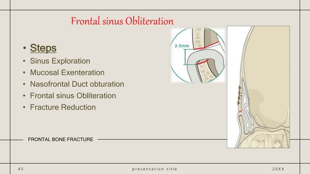 FRONTAL BONE FRACTURE AND ITS MANAGEMENT.pptx | Death, Injury, or ...