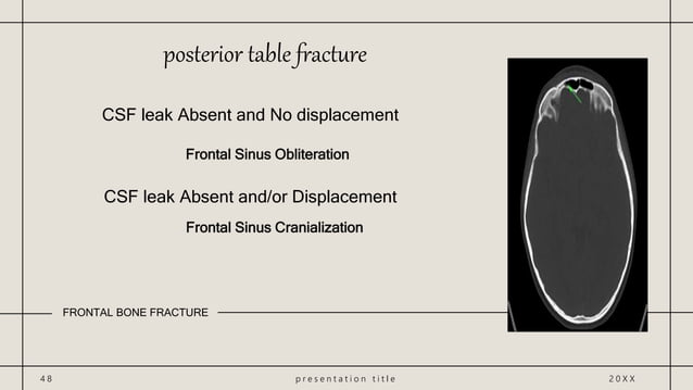 FRONTAL BONE FRACTURE AND ITS MANAGEMENT.pptx | Death, Injury, or ...