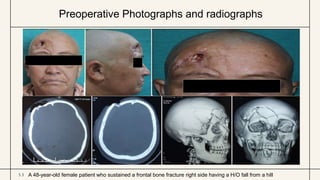 FRONTAL BONE FRACTURE AND ITS MANAGEMENT.pptx