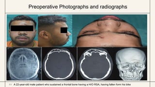 FRONTAL BONE FRACTURE AND ITS MANAGEMENT.pptx