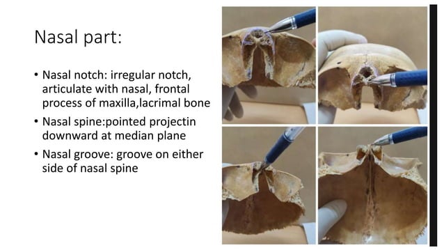 Frontal bone ppt (1) | PPTX