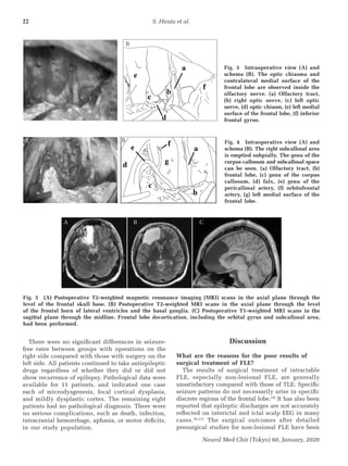 frontal lobectomy.pdf 11 surgical details | PDF